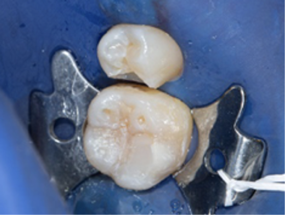 Clinical Guide: Class II Restoration on a Mandibular Second Premolar