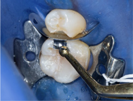 Clinical Guide: Class II Restoration on a Mandibular Second Premolar