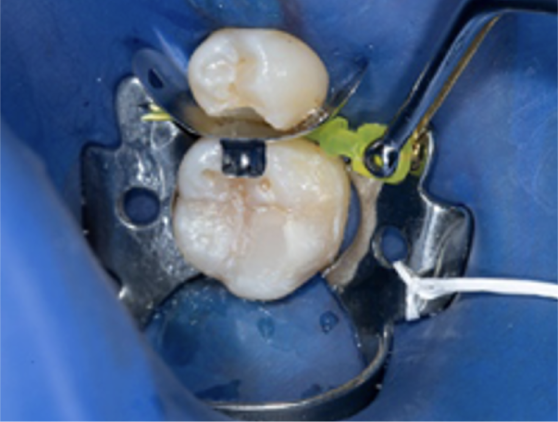 Clinical Guide: Class II Restoration on a Mandibular Second Premolar
