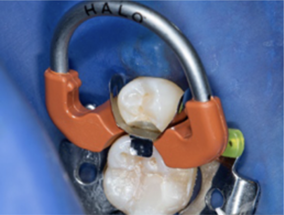 Clinical Guide: Class II Restoration on a Mandibular Second Premolar