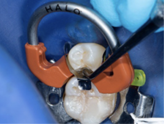 Clinical Guide: Class II Restoration on a Mandibular Second Premolar
