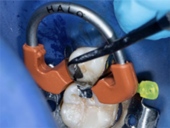 Clinical Guide: Class II Restoration on a Mandibular Second Premolar