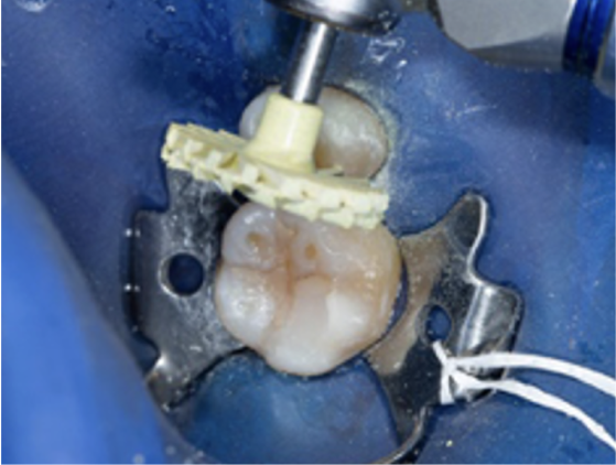 Clinical Guide: Class II Restoration on a Mandibular Second Premolar