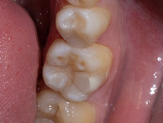 Clinical Guide: Class II Restoration on a Mandibular Second Premolar