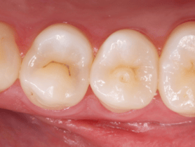 Clinical Guide: Class II Restoration of First Premolar with ...