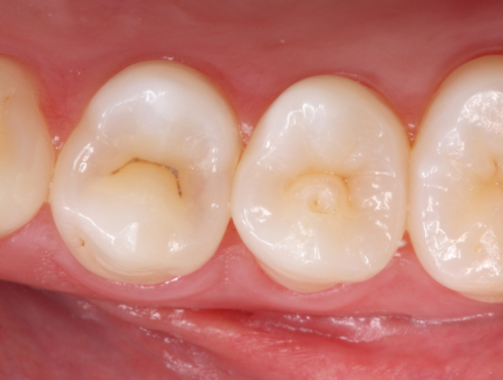 Clinical Guide: Class II Restoration of First Premolar with ...