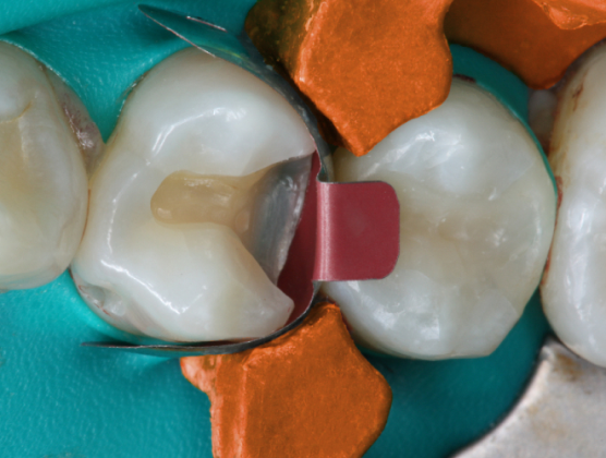 Clinical Guide: Class II Restoration of First Premolar with ...