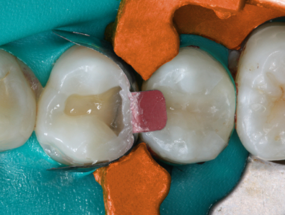 Clinical Guide: Class II Restoration of First Premolar with ...