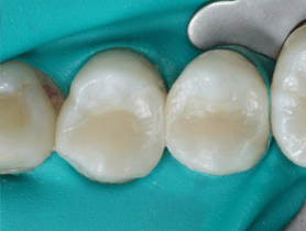 Clinical Guide: Class II Restoration of First Premolar with ...