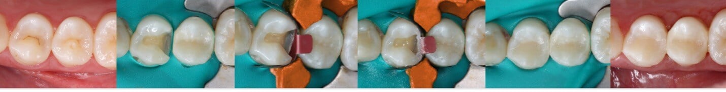 Clinical Guide: Class II Restoration of First Premolar with ...