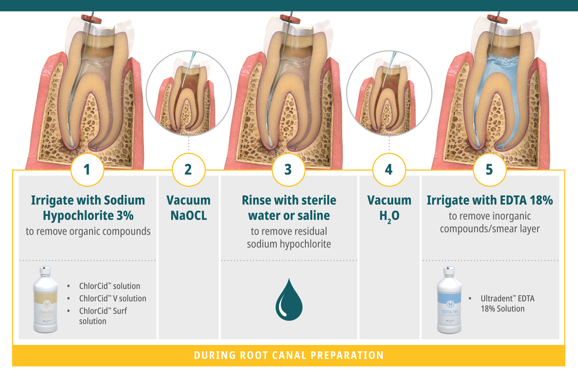 Clinical Guide: Endodontic Irrigation Protocol