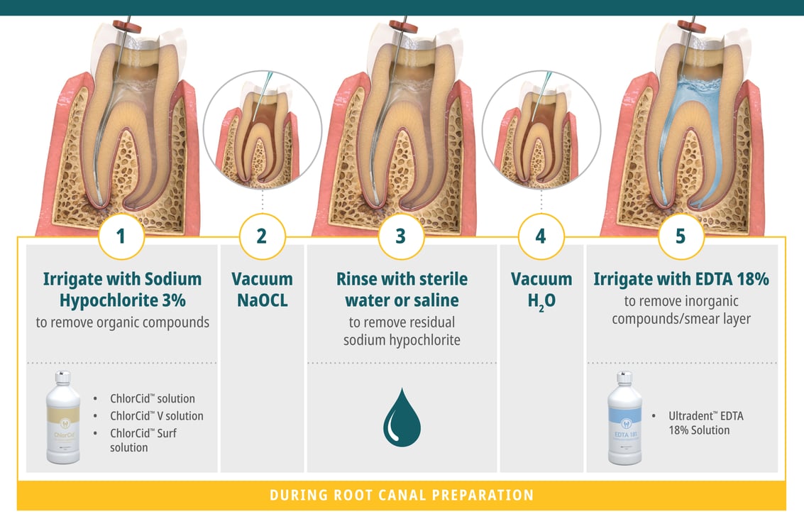 Clinical Guide: Endodontic Irrigation Protocol