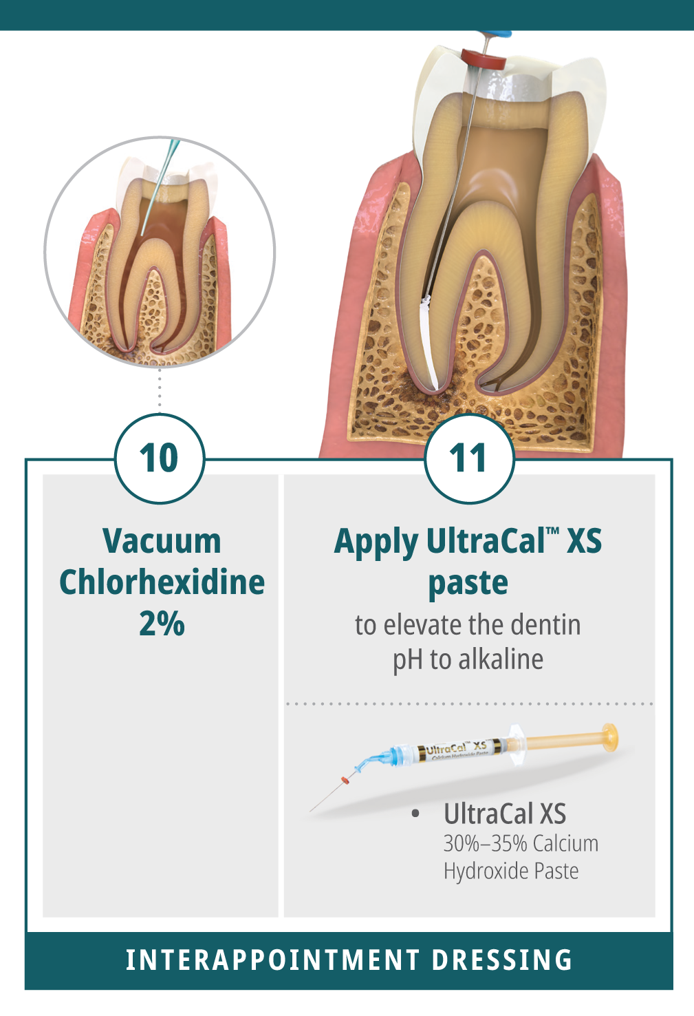 Clinical Guide: Endodontic Irrigation Protocol