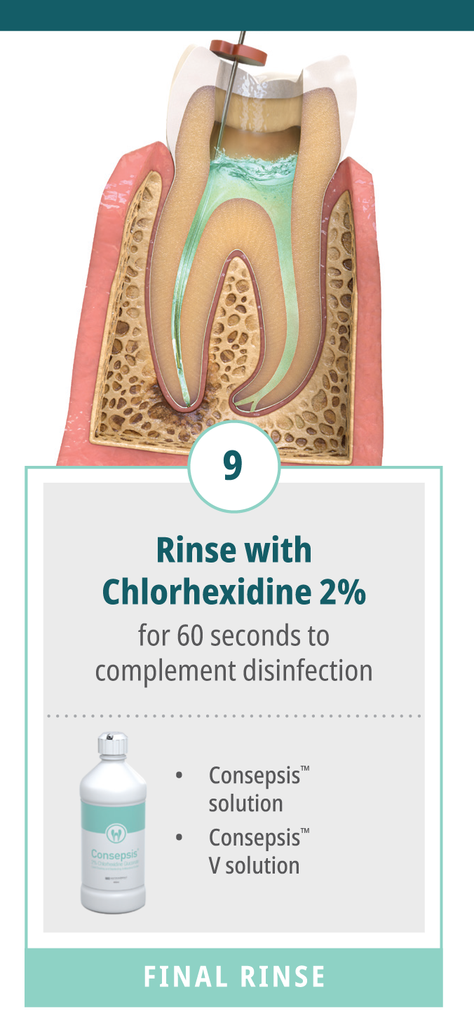 Clinical Guide: Endodontic Irrigation Protocol