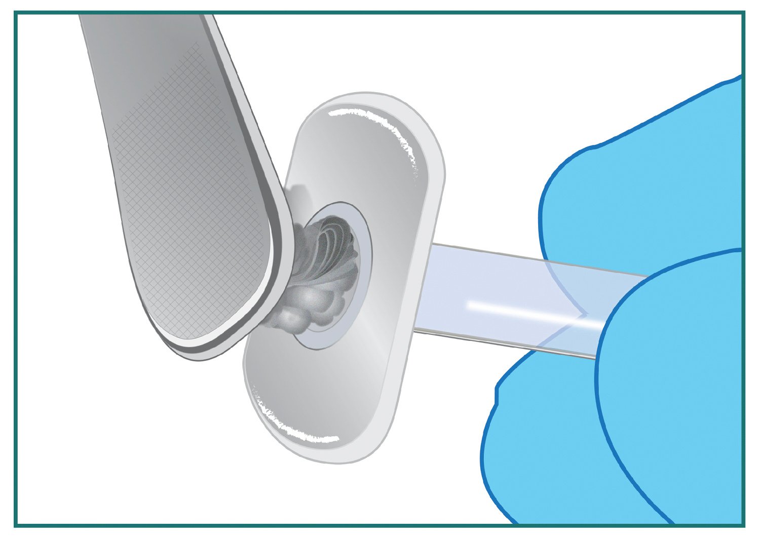 A Simple Guide to Easy Endo Repairs with Endo-Eze™ MTAFlow™ Cement