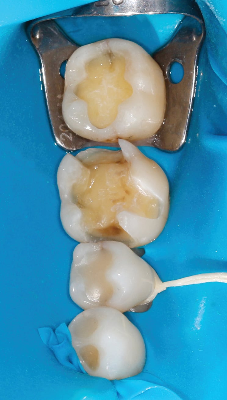 Clinical Guide: Transcend Composite