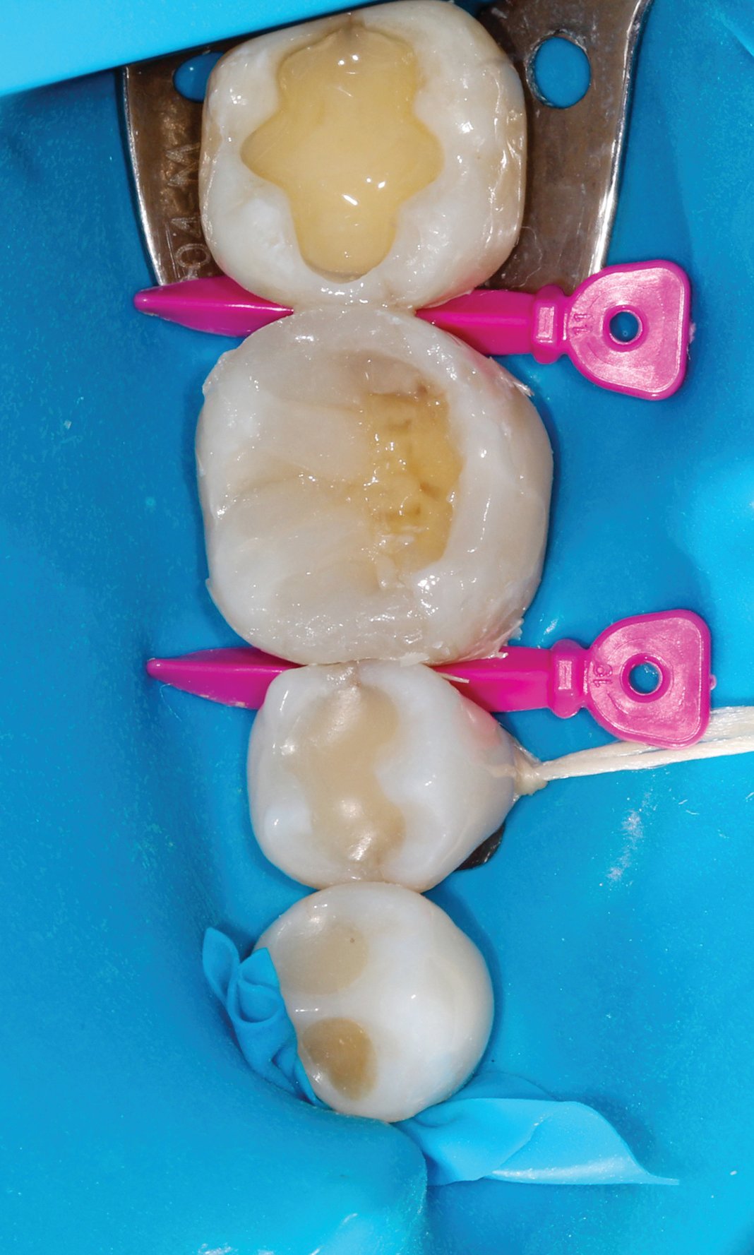 Clinical Guide: Transcend Composite