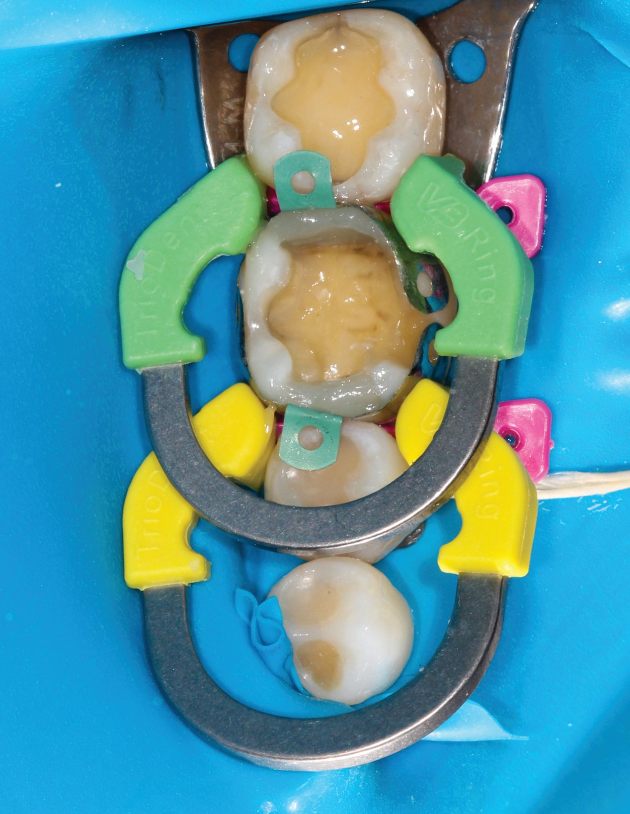 Clinical Guide: Transcend Composite