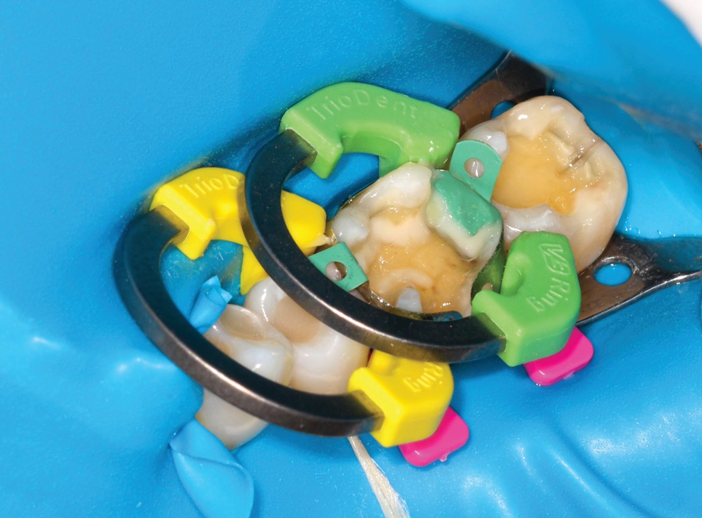 Clinical Guide: Transcend Composite