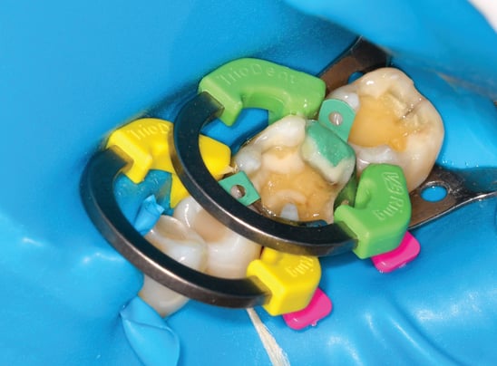 Clinical Guide: Transcend Composite