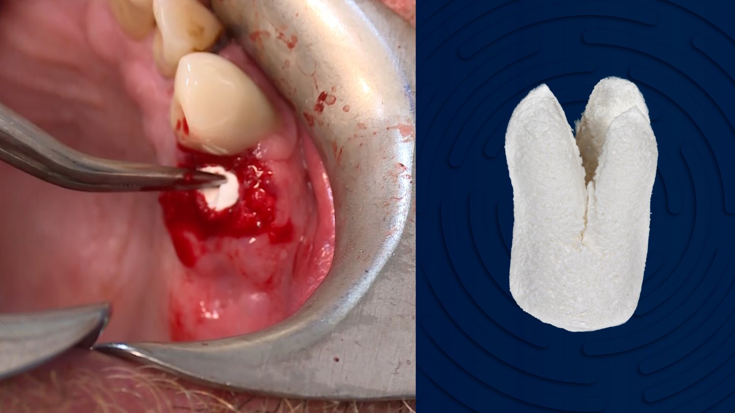 OsteoGen® Plug: Clinical Guide