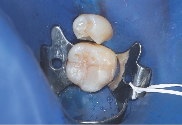 Clinical Guide: Class II Restoration of Tooth #29