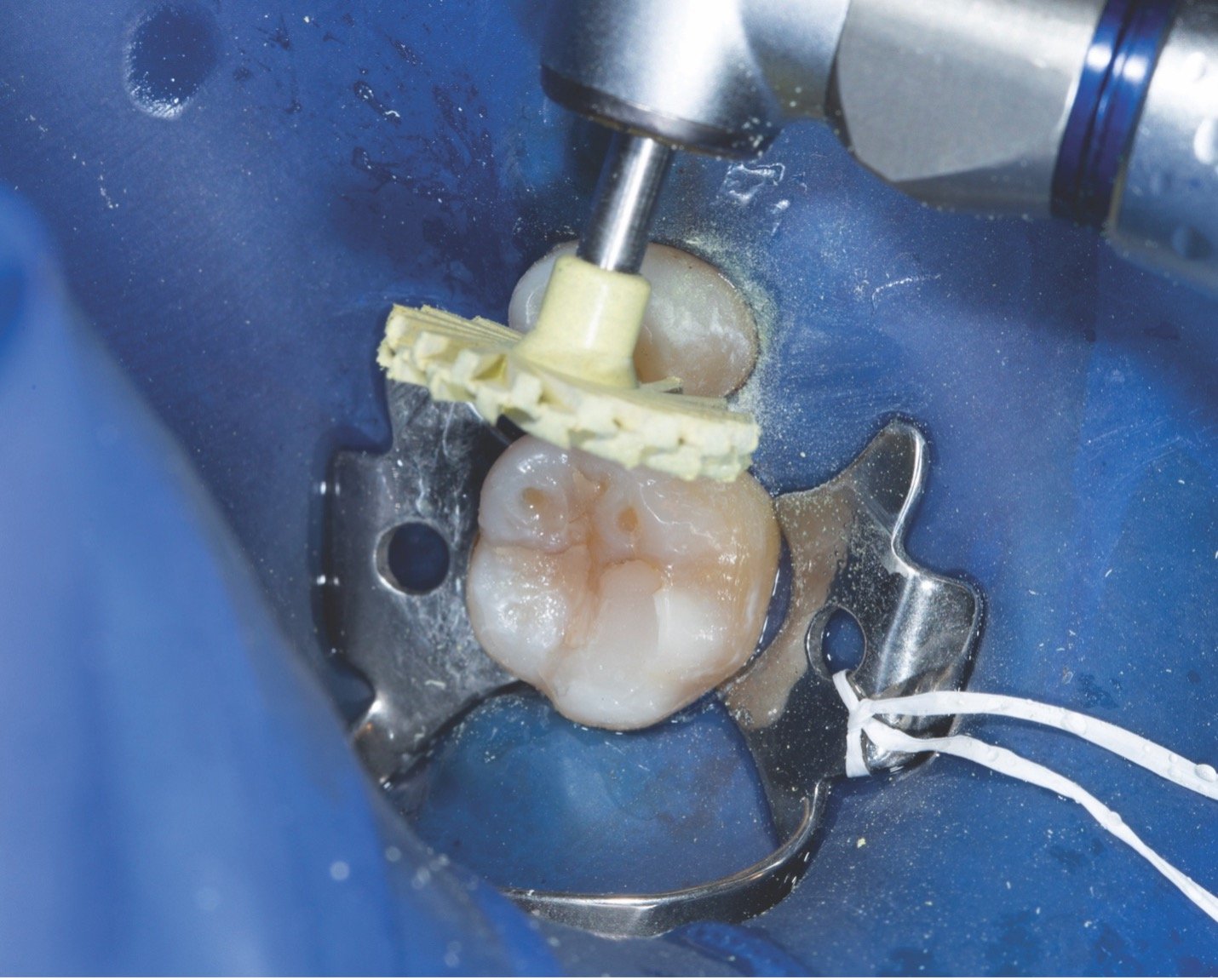 Clinical Guide: Class II Restoration of Tooth #29