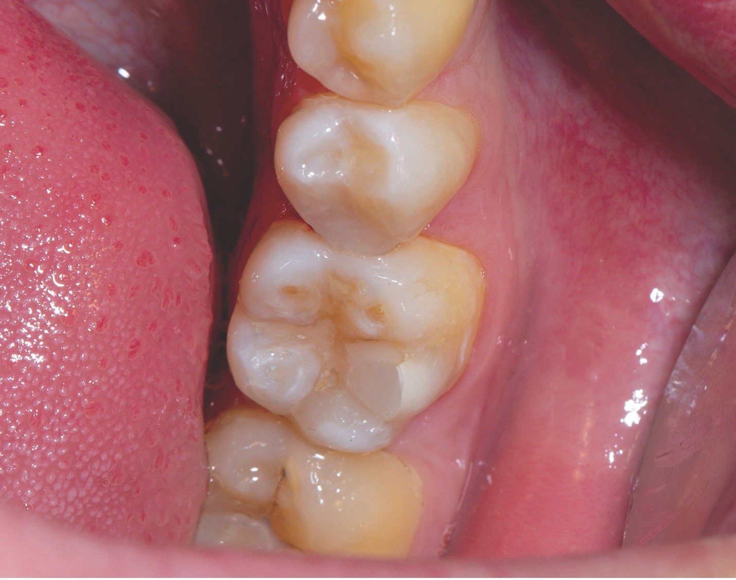 Clinical Guide: Class II Restoration of Tooth #29