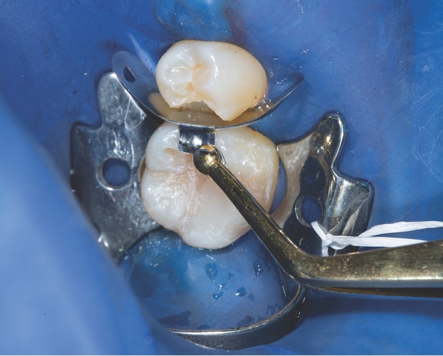 Clinical Guide: Class II Restoration of Tooth #29