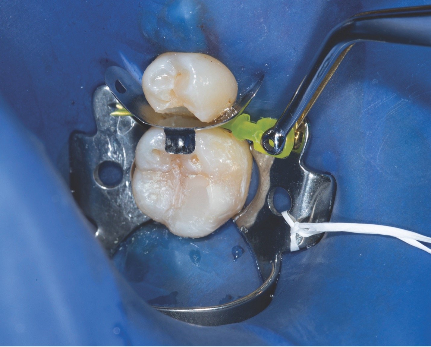 Clinical Guide: Class II Restoration of Tooth #29