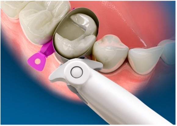 Circumferential Vs. Sectional Matrix Bands