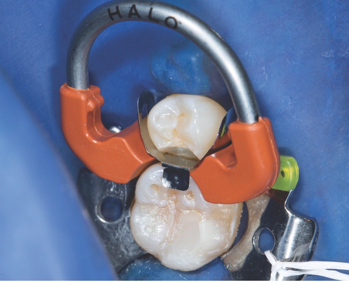 Clinical Guide: Class II Restoration of Tooth #29