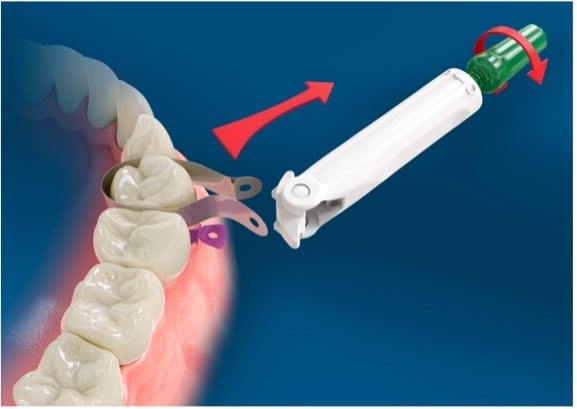 Circumferential Vs. Sectional Matrix Bands