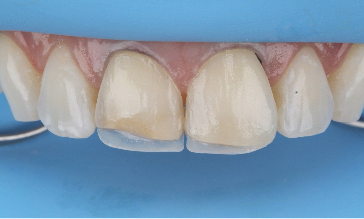 Clinical Guide: Esthetic Restoration of Maxillary Central Incisors
