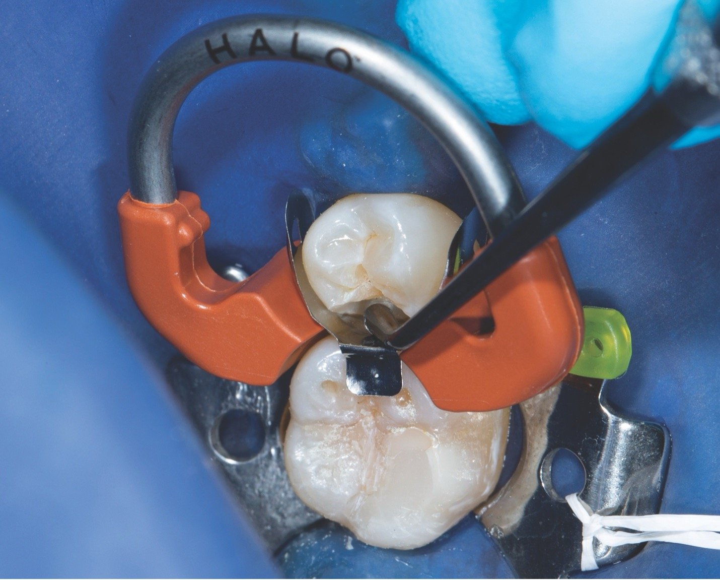 Clinical Guide: Class II Restoration of Tooth #29