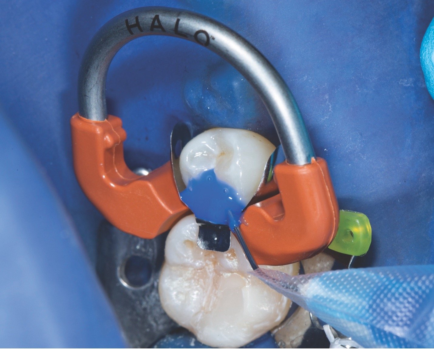 Clinical Guide: Class II Restoration of Tooth #29