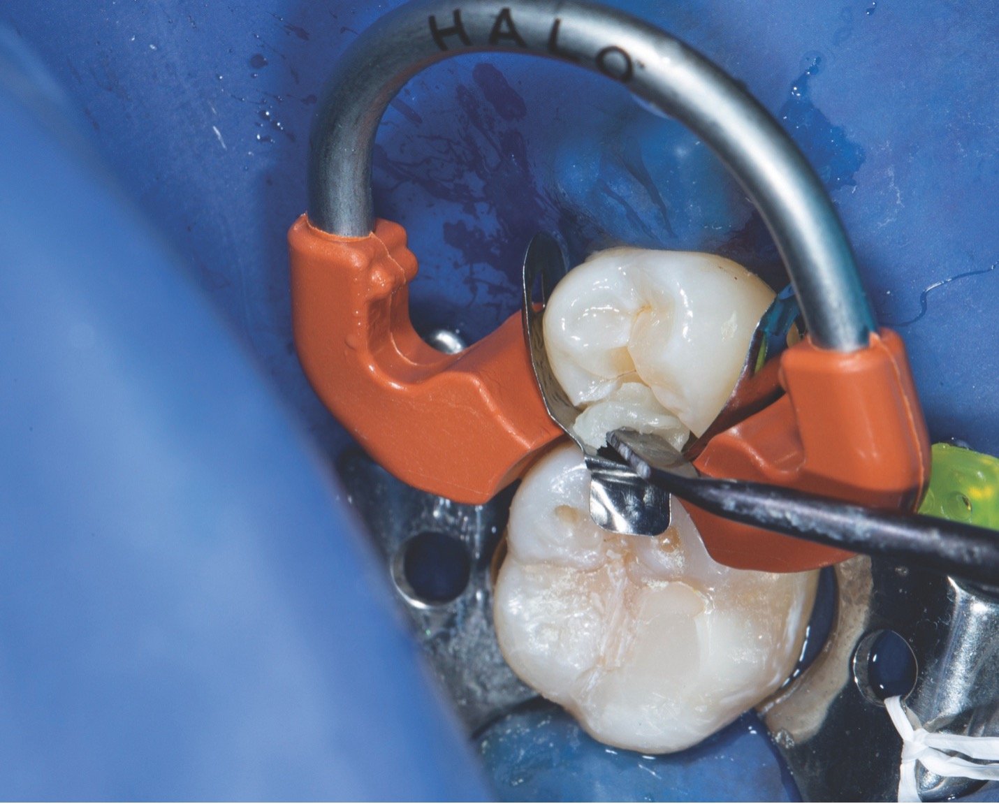 Clinical Guide: Class II Restoration of Tooth #29