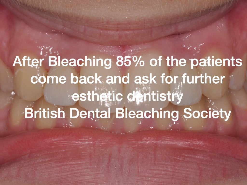 Unlocking the Power of Teeth Whitening: A Comprehensive Approach