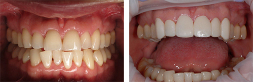 The Reviews Are In: Uveneer™ Direct Composite Veneer Template System